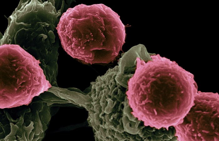 Nueva terapia acorta tratamiento de cáncer de amígdalas y lengua ...